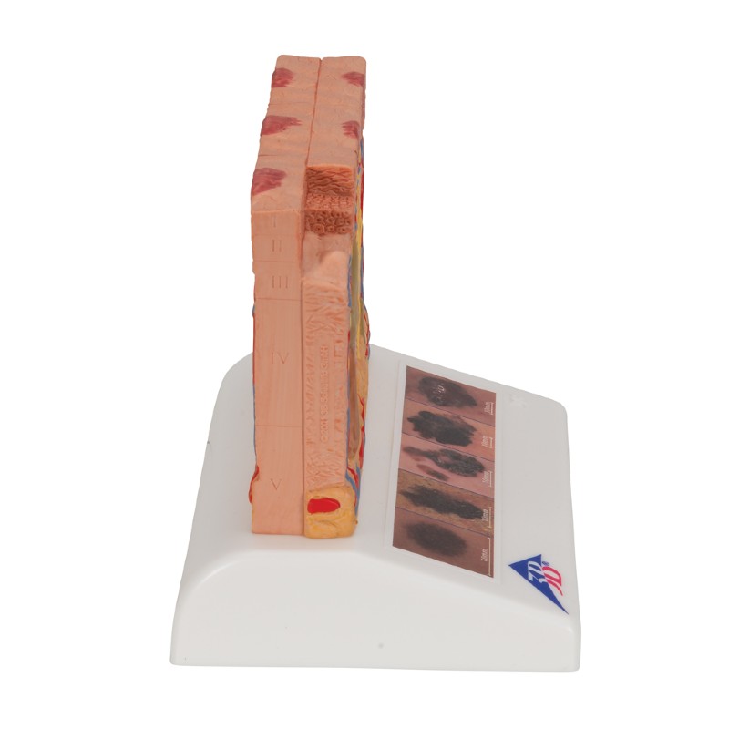 3B Scientific Magnified Skin Cancer Model | Health and Care